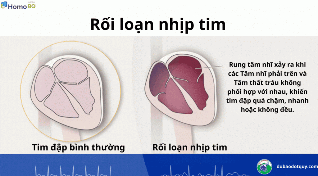 Nhịp Tim Không Đều: Nguyên Nhân, Triệu Chứng và Cách Điều Trị - Thư ...