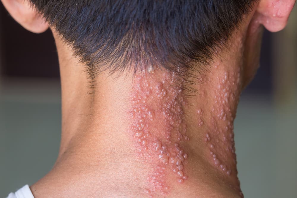 Thuốc bôi zona: hỗ trợ điều trị nhanh khỏi và giảm triệu chứng bệnh ...